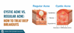 Cystic Acne vs. Regular Acne: How to Spot & Treat Deep Breakouts